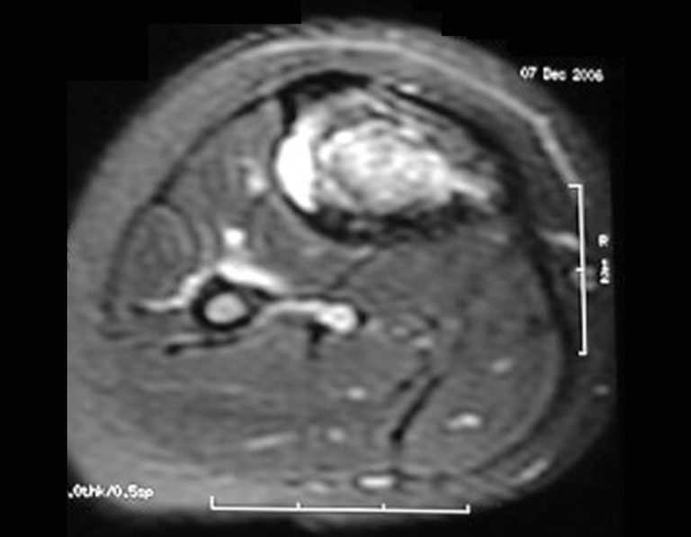 Sarcoma de Ewing da tíbia - Oncocirurgia