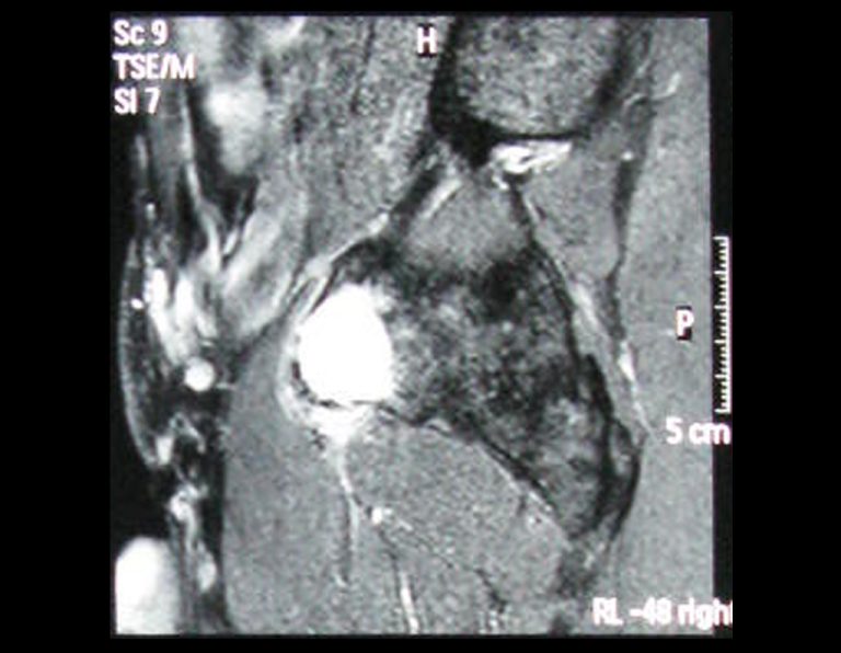 Metástase de Câncer Renal - Oncocirurgia