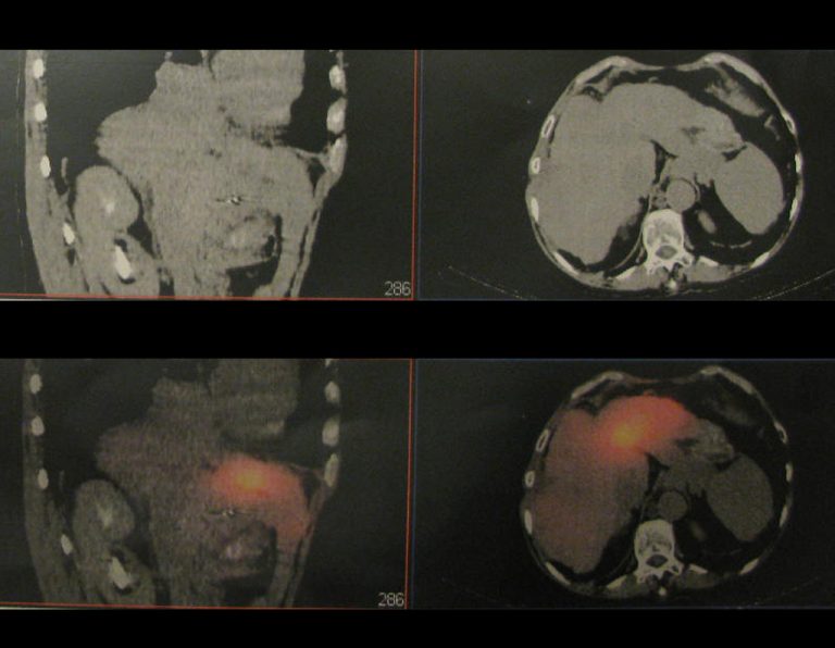Metástase de Hepatocarcinoma - Oncocirurgia